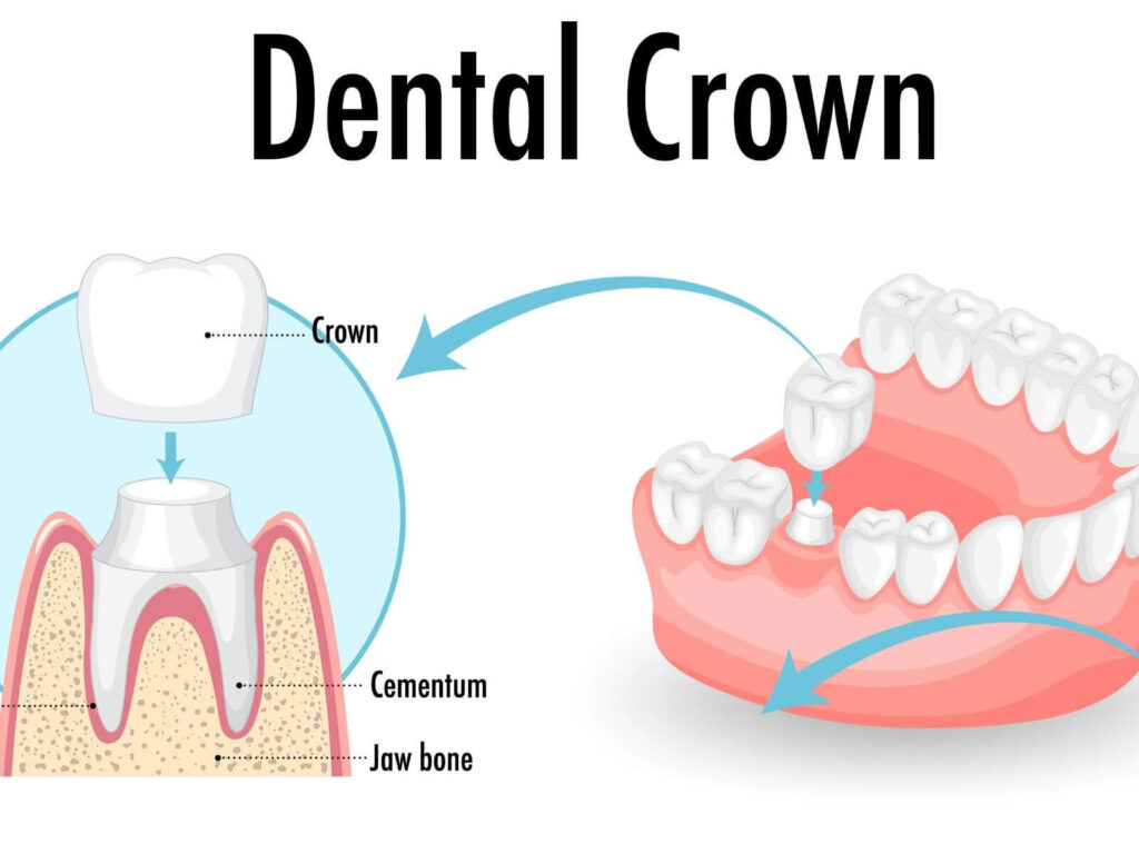 How To Take Care of a Dental Crown